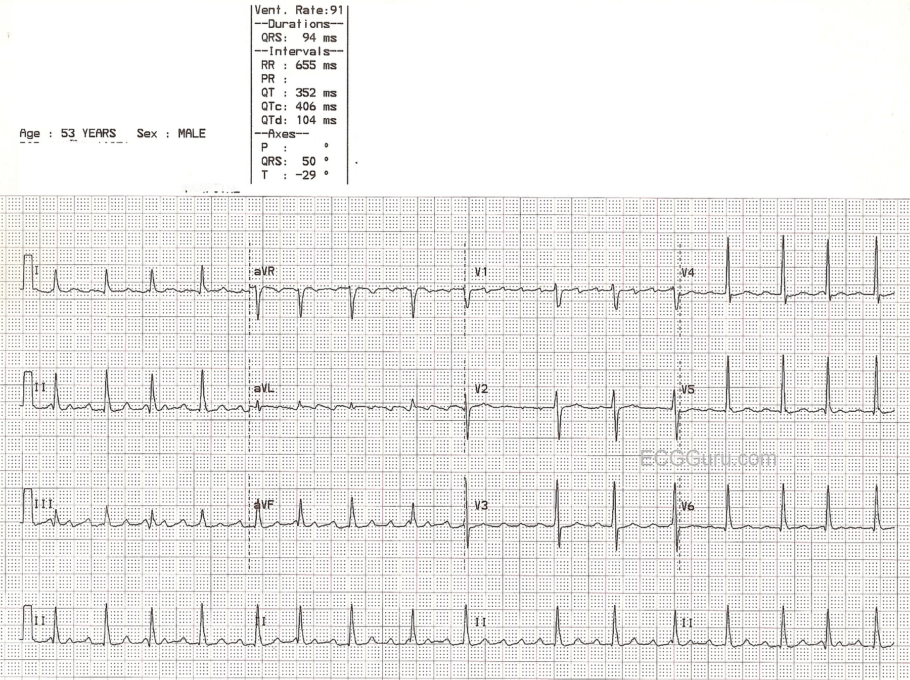 Ecg Basics Atrial Flutter With Variable Conduction Ecg Guru Images And Photos Finder